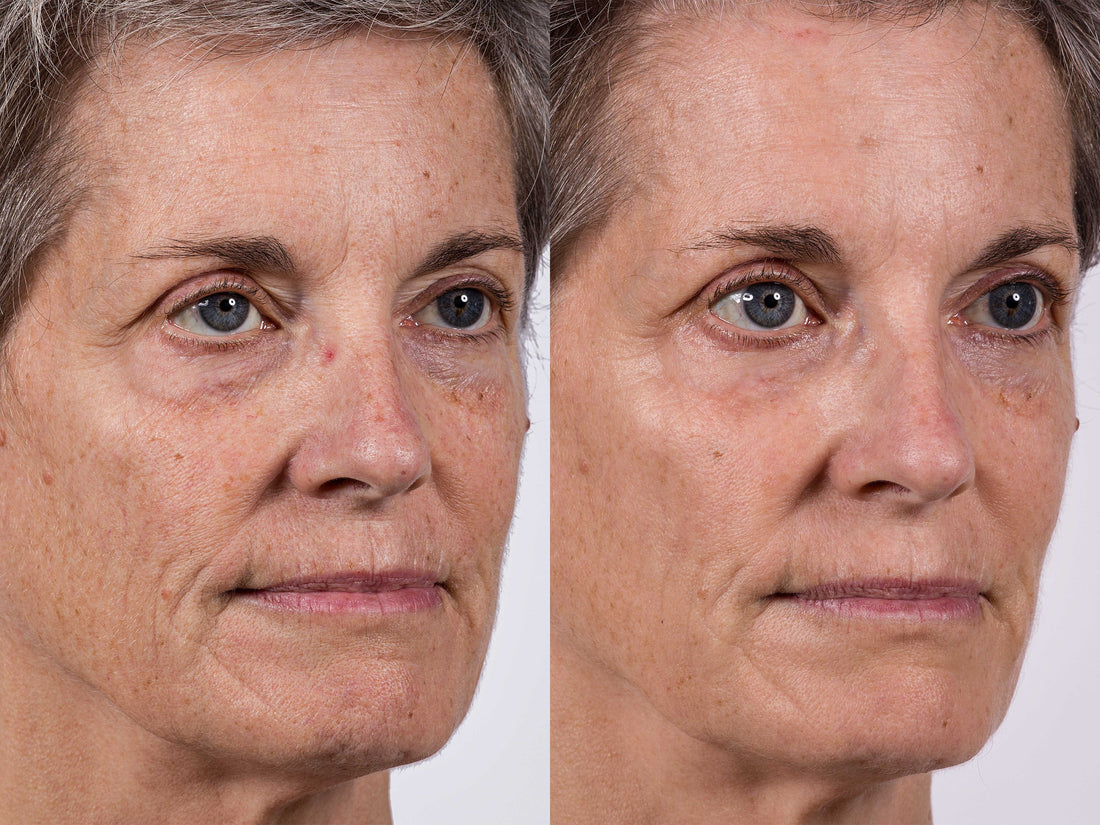 Before & After Skincare Results by Elizabeth Grant – Elizabeth Grant ...